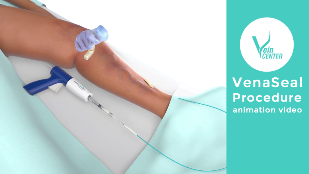 VenaSeal & Sclerotherapy! Best for Varicose Veins #1 Treatment - Vein ...